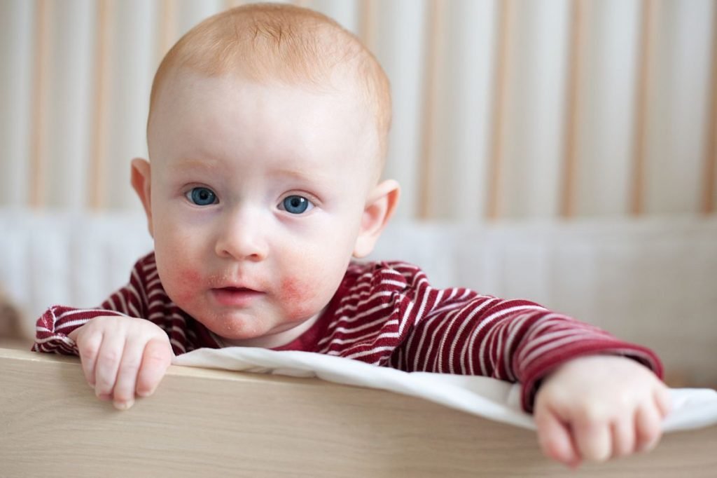 Dermatitis In Children: Most Frequent Areas, How To Treat It